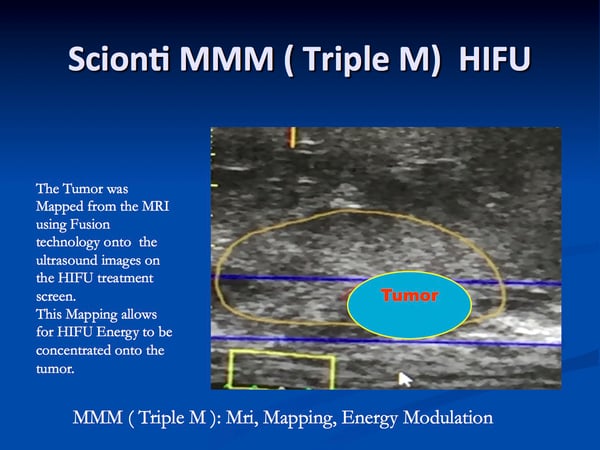 Hifu Prostate Cancer Treatment Specialist Dr Scionti Experience Matters